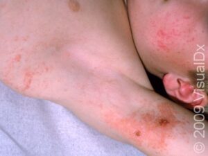 Allergic Contact Dermatitis (Pediatric) Condition, Treatments and ...