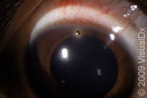 Foreign Object in Eye or Skin, First Aid Condition, Treatments and ...